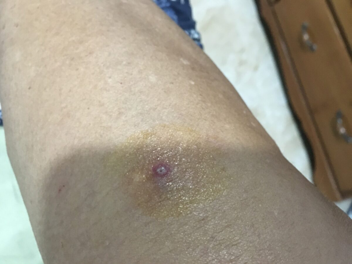 A mysterious infection poses an itchy problem for this CAD patient